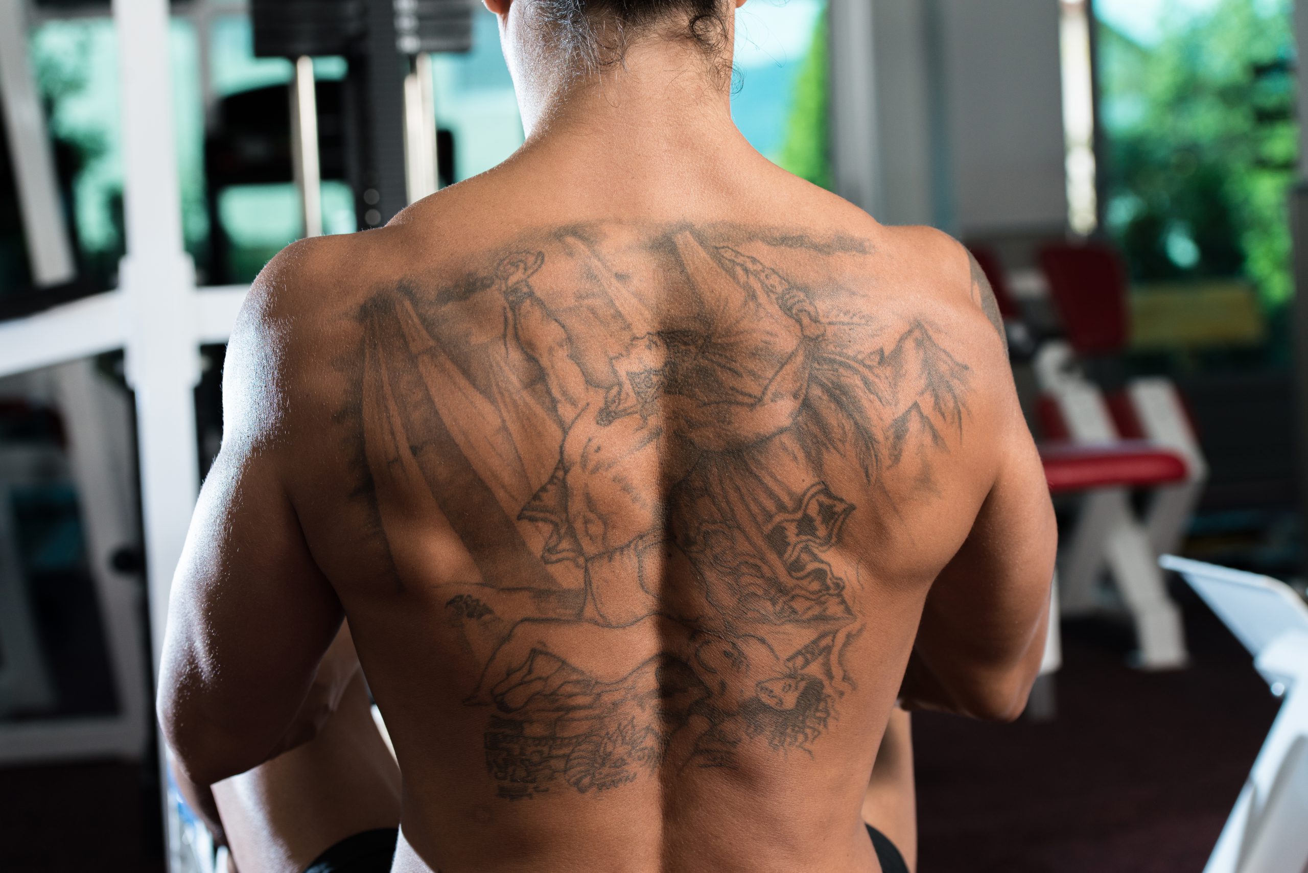 Como remover tatuagens, queloides e cicatrizes de acne? - Juliana Rangel